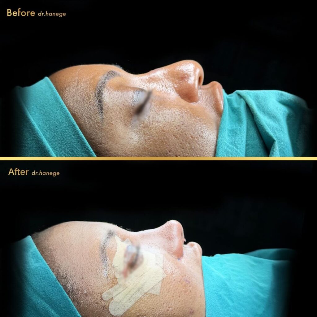 Bulbous Nose Tip Correction in Ethnic Rhinoplasty - Dr. Hanege