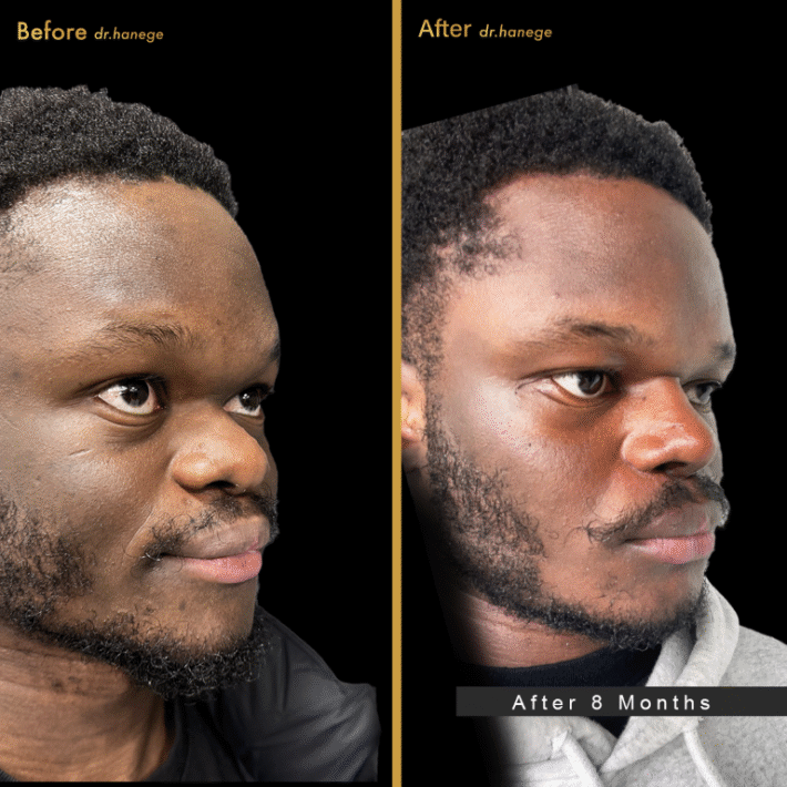 Rhinoplasty for Men: Tailoring the Male Nose - Dr. Hanege